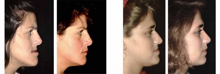 PROGNATISMO MANDIBULAR - CIRURGIA ORTOGNÁTICA