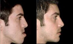 PROGNATISMO MANDIBULAR - CIRURGIA ORTOGNÁTICA